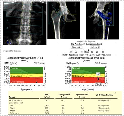 Bone Density Test Cpt Code 2025 Leah J Rimmer