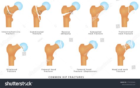 Proximal Femur Fracture