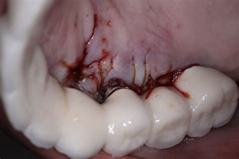Root Fragment Removal And Grafting Of Defect Cases And Questions Osseonews