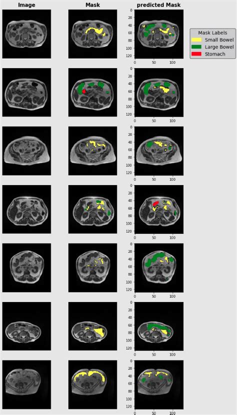 GitHub Ismailazdad Uwmgit UW Madison GI Tract Image Segmentation