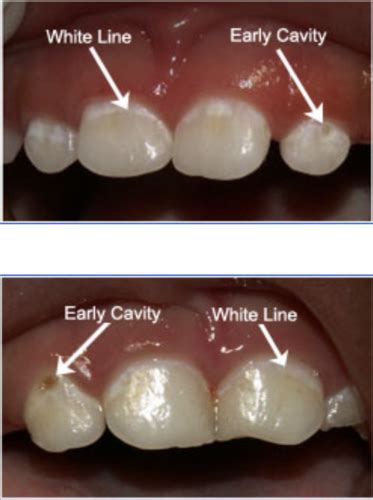 Caries Risk Assessment Fluoride Varnish And Counseling Flashcards Quizlet