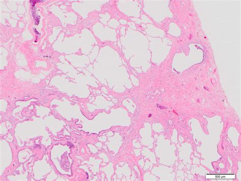 Idiopathic Pulmonary Fibrosis Histology