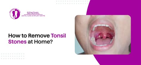 How To Remove Tonsil Stones At Home Safely Expert Guide