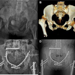 A B X Ray And Computed Tomography Scan Images Of A 21 Year Old Woman Download Scientific