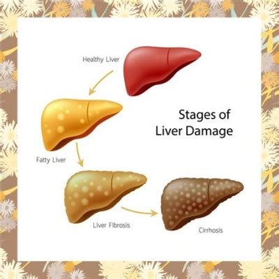 간경화 초기증상 포함 간경화 증상 치료 및 관리 네이버 포스트