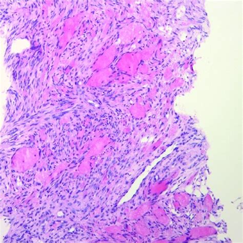 Lytic Bone Lesion Of The Right L1 Transverse Process Hematoxylin Eosin Download Scientific