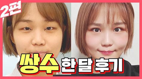 쌍수 한달 후기 쌍꺼풀 수술하고 눈이 2배로 커졌다😍 진작 할 걸 왜 이제야 했지 눈성형 Vlog 2편 쌍수부기쌍수부작용