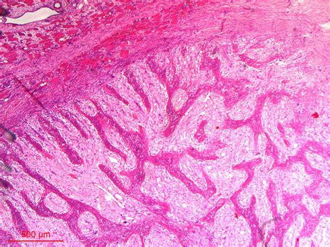 Pathology Outlines Myositis Ossificans