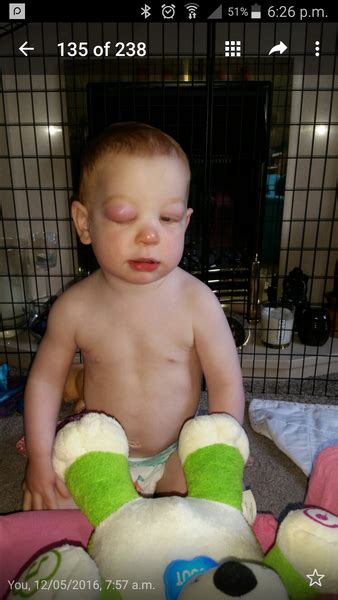 Could This Be Cellulitis Photo Mumsnet