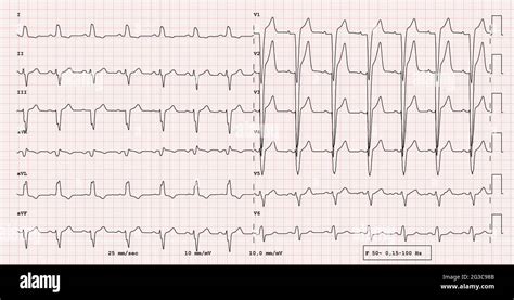 Left Bundle Branch Block Ecg