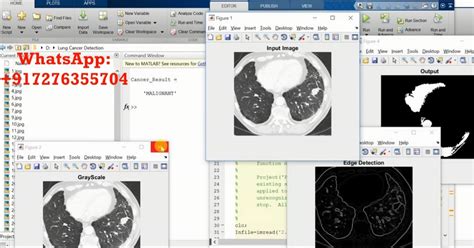 Lung Cancer Detection Using Image Processing Matlab Project Source Code