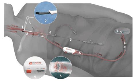 Transcarotid Artery Revascularization Tcar Tinley Park Il