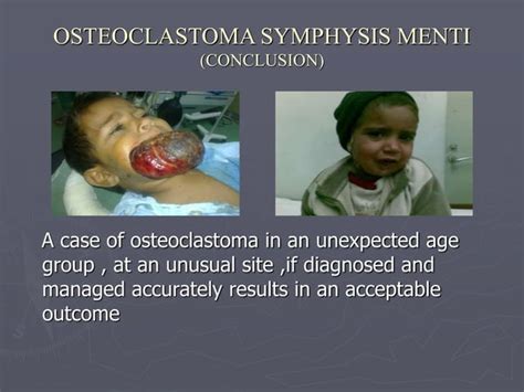 Osteoclastoma Symphysis Menti A Case Report Ppt Bone And Joint