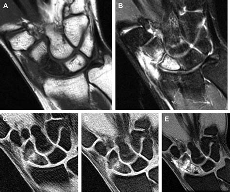 Imaging For Acute And Chronic Scaphoid Fractures Hand Clinics