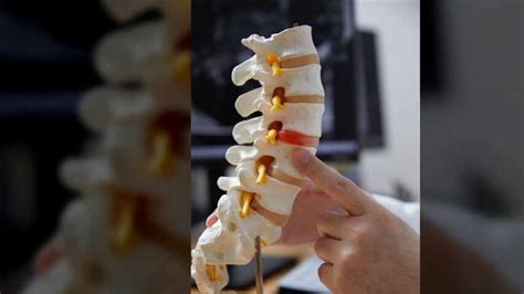 허리협착증수술방법 필요한 시기와 예방하려면 네이버 포스트