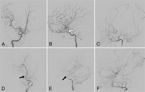 A B Right Ica Angiogram In Frontal A And Lateral View B Showing Download Scientific