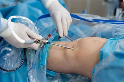 특수 장비를 들고 무릎에 수술을 제공하는 보호 장갑을 착용 외과 의사 의학 개념 수술에 대한 스톡 사진 및 기타 이미지 수술 무릎 외과 의사 Istock