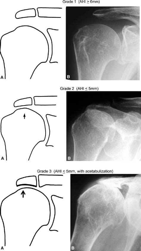 Rotator Cuff Tear Icd 10 Right At Bill Schoenfeld Blog