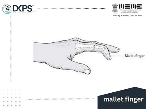 Mallet Finger Drsinghphysiocare