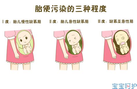 十月菌教你预防胎便吸入综合征
