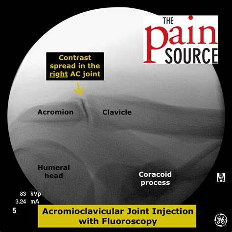 Cortisone Injection Subacromial Bursa At Werner Obrien Blog