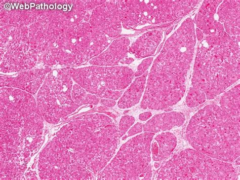 Hibernoma Microscopic Features