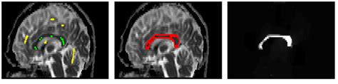 Segmentation Of A Real Dt Mri Brain Dataset Initial With Seeds
