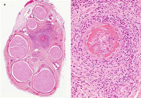 Vasculitic Neuropathy Neupsy Key