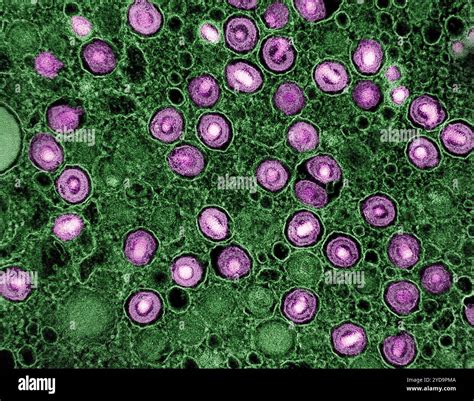 Transmission Electron Micrograph Of Cytomegalovirus Cmv Particles Pink