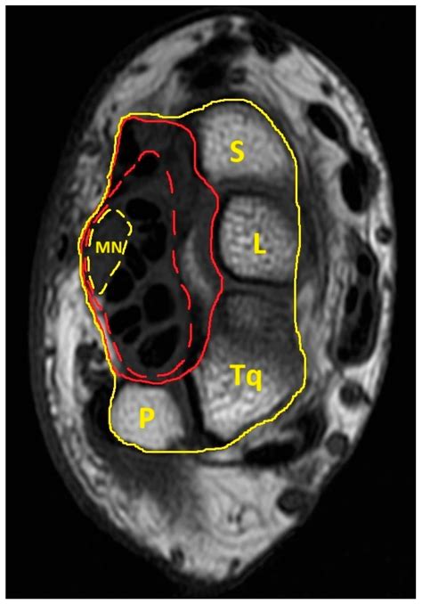 Comparing The Carpal Tunnel Area And Carpal Boundaries In Patients With