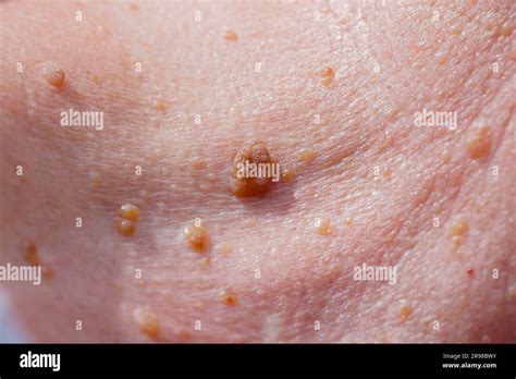 Mole Examination Hi Res Stock Photography And Images Alamy
