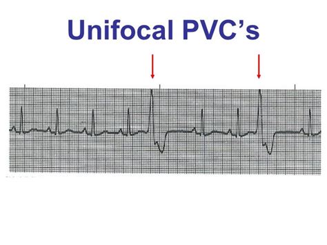 Ventricular Rhythms Bmh Tele