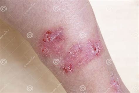 Rash Hives Itchy Skin On Legs Inflammation And Allergy Disease On