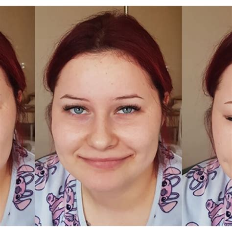 5 6 patient after 2 hours after tonsillectomy full recovery of download scientific diagram