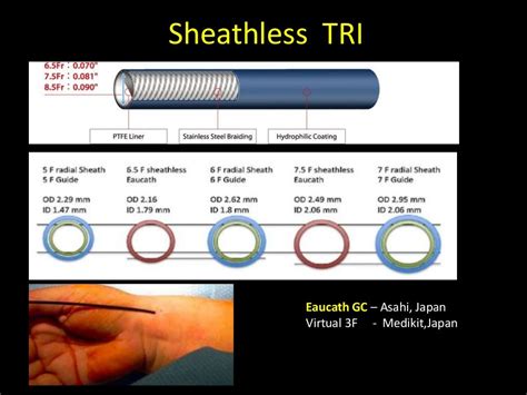 Choice Of Guiding Catheters In Pci