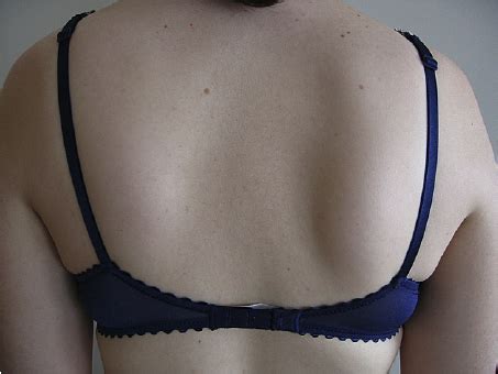 Winging Of The Right Scapula Download Scientific Diagram