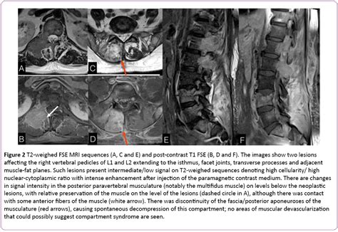 Multifidus Muscle Mri