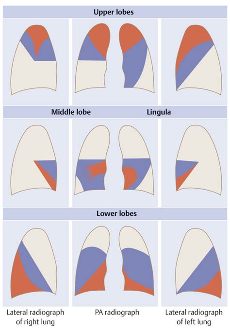 Lung And Pleura Radiology Key