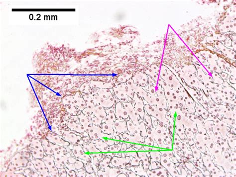 Hepatitis B Libre Pathology