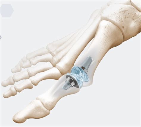 Rts 1st Mtp Joint Replacement Lavender Medical