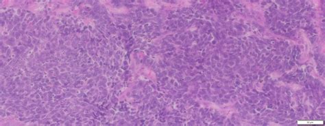 Human Small Cell Lung Cancer Ffpe Sections