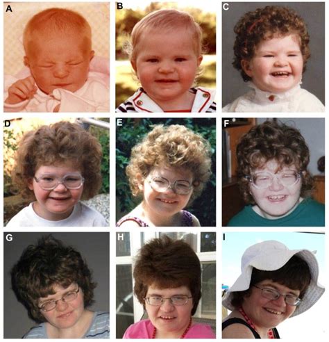 Chromosome Deletion Disorders