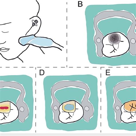 Schematic Representation Of A Ultrasound Guided Trigeminal Nerve Download Scientific Diagram