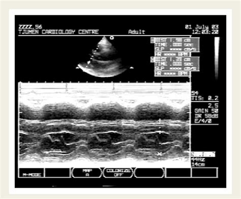M Mode Echocardiogram Of Left Ventricle In Patients With Asymmetrical Download Scientific