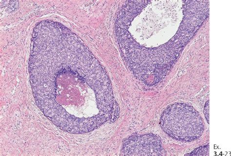 Multiple Clusters Of Crushed Stone Like Calcifications On The Mammogram Produced By Malignant
