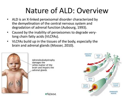 Ppt X Linked Adrenoleukodystrophy Ald Powerpoint Presentation Free