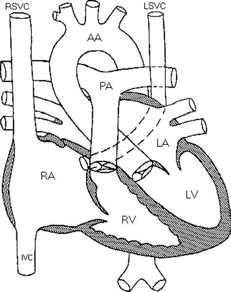 Lingual Tonsillectomy Artofit