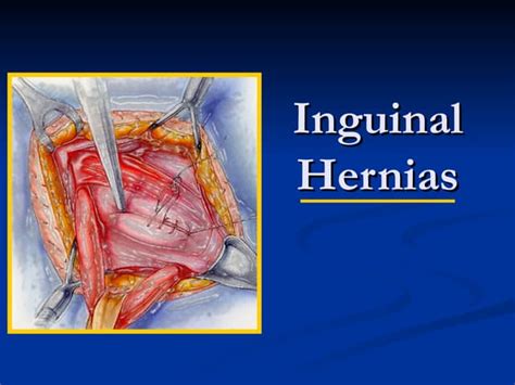 Inguinal And Femoral Hernia Pptx