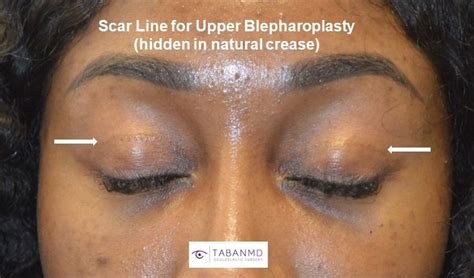 Upper Blepharoplasty Scars