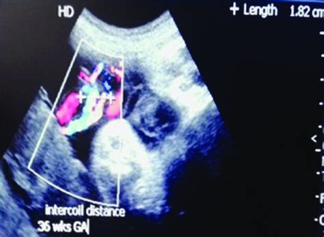 Normal Intercoil Distance Umbilical Coiling Index 055 At 36 Weeks